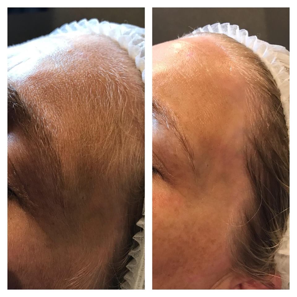 Everything You Need to Know About Dermaplaning! – The Therapy Rooms at ...